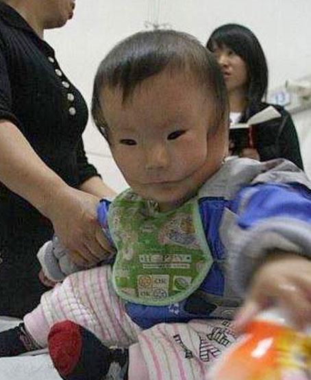 Baby in China Born with Second Face